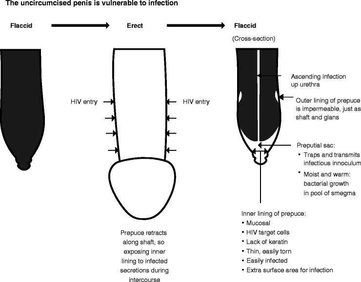 The Role of Circumcision in Preventing STIs | Springer for Research ...