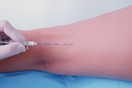 Distale N.-ischiadicus-Blockade (Poplitealblock) | SpringerLink