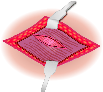 A12 Gridiron, Lanz and Rutherford Morison Incisions | SpringerLink