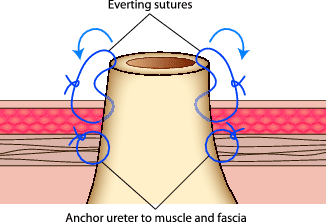 G10 Ureterostomy | SpringerLink