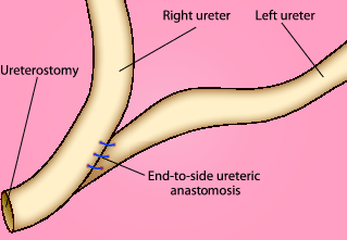 G10 Ureterostomy | SpringerLink