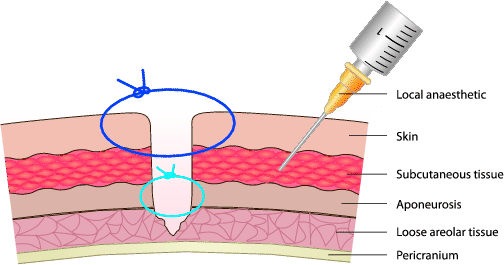 B1 Layers of the Scalp and Suturing | SpringerLink