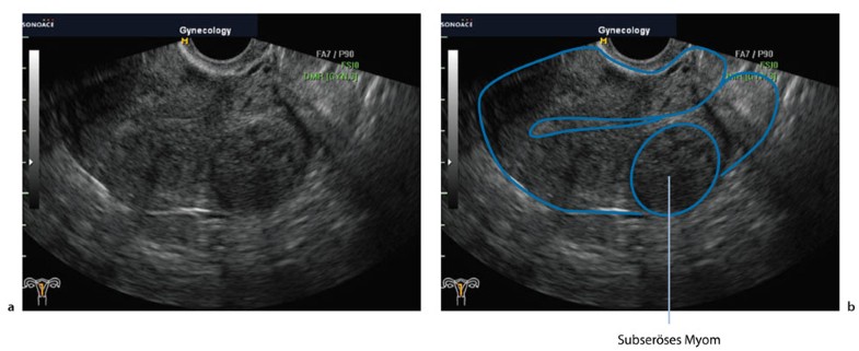 Gynäkologischer Ultraschall | SpringerLink