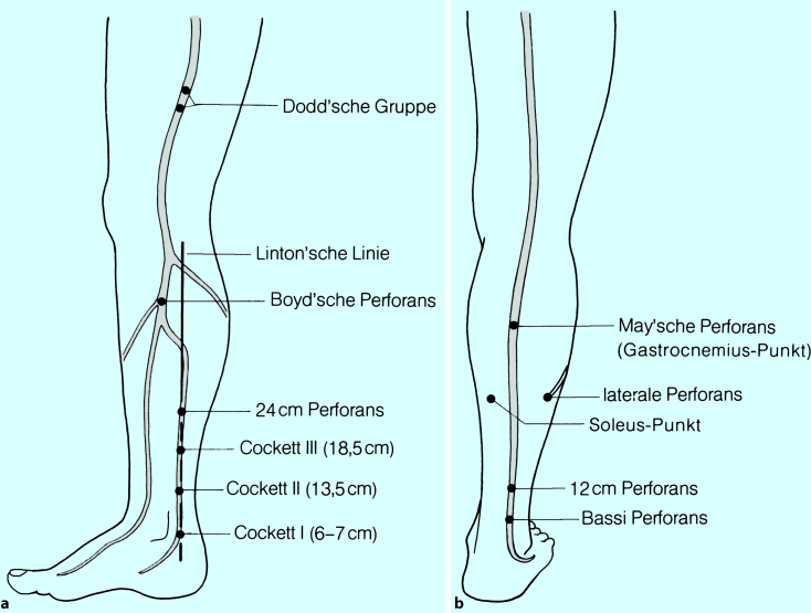 Varikose | SpringerLink