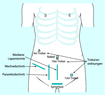 Appendizitis | SpringerLink