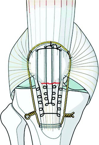 Patellar Fractures | SpringerLink