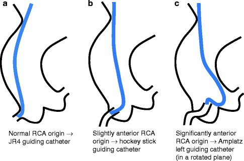 Guiding Catheters | SpringerLink