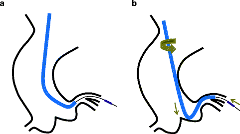 Guiding Catheters | SpringerLink