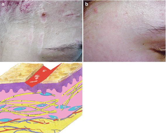Pathological Scars (Keloid and Hypertrophic Scars) | SpringerLink