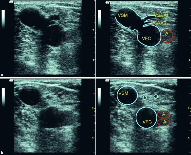Untersuchung der Vena saphena magna | SpringerLink