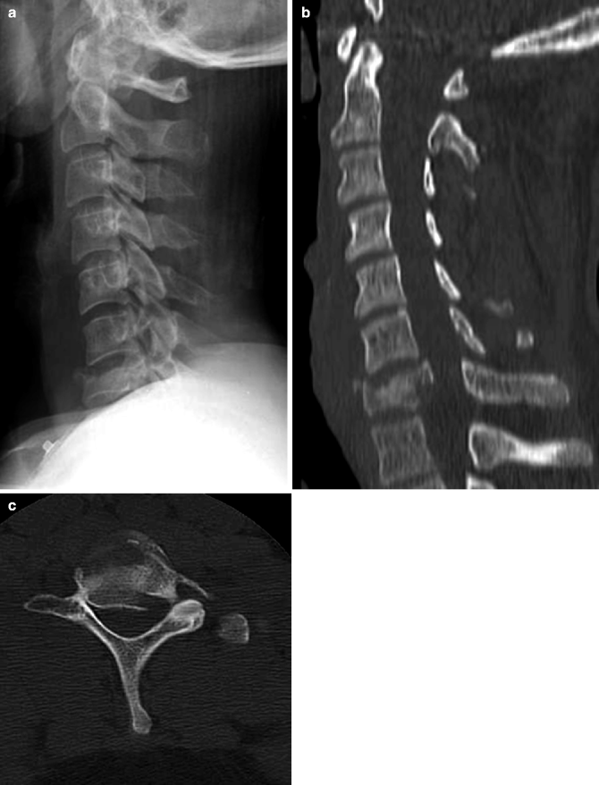 Spine Trauma: Subaxial Cervical Spine (C3–C7) | SpringerLink