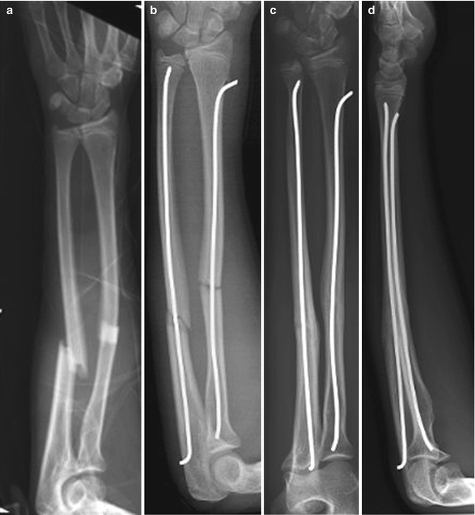 Flexible Intramedullary Nailing (FIN) in Diaphyseal Fractures in ...