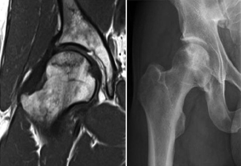 Principles of Core Decompression for Osteonecrosis of the Hip ...