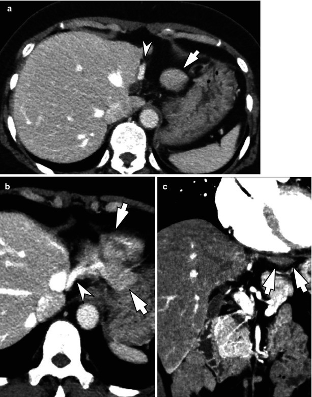 Anomalies and Anatomic Variants of the Liver | SpringerLink