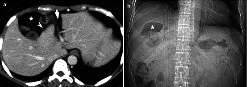 Anomalies and Anatomic Variants of the Liver | SpringerLink