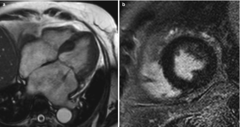 Restrictive Cardiomyopathy | SpringerLink