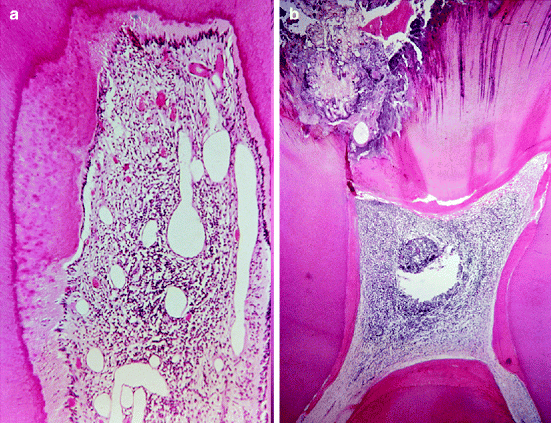 Disorders of the Dental Pulp | SpringerLink