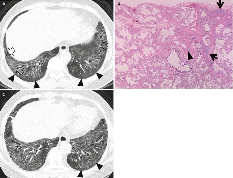 Ground-Glass Opacity with Reticulation | SpringerLink