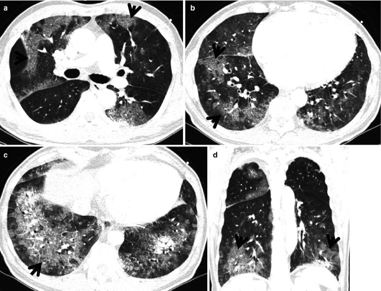 Ground-Glass Opacity with Reticulation | SpringerLink