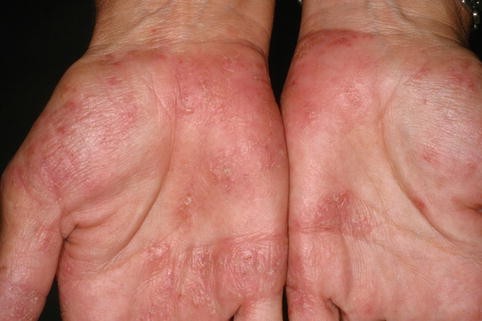Acute and Recurrent Vesicular Hand Eczema | SpringerLink