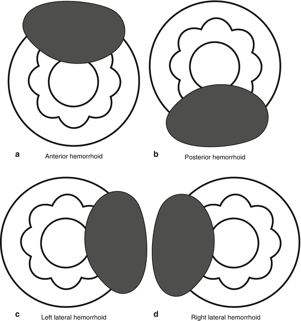 The Pathophysiology of Hemorrhoids | SpringerLink