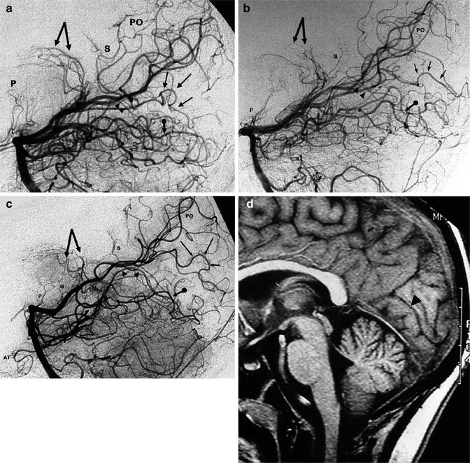 Posterior Cerebral Artery | SpringerLink
