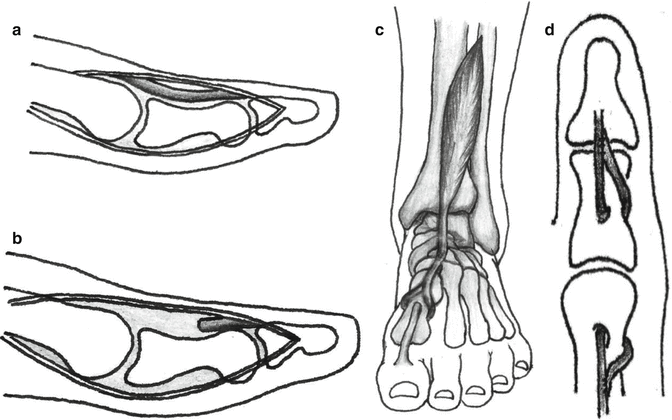 Tendon Disorders of Foot and Ankle | SpringerLink