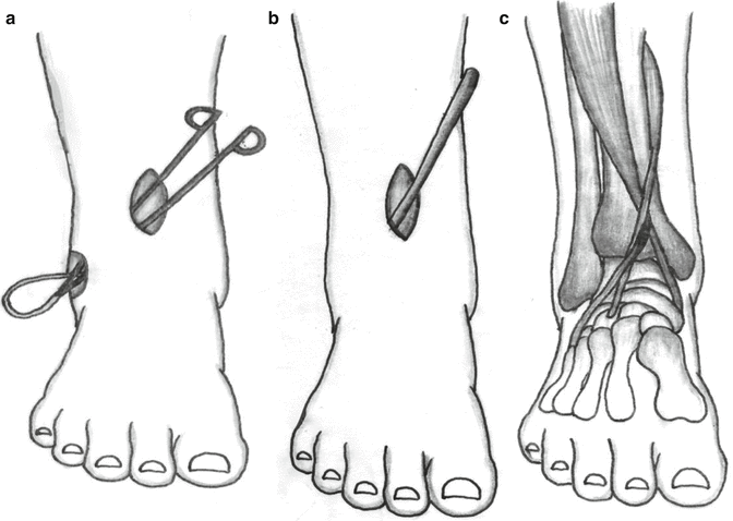 Tendon Disorders of Foot and Ankle | SpringerLink