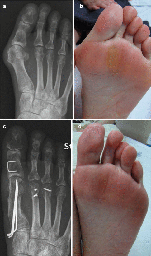 Metatarsalgia and Toe Deformities | SpringerLink