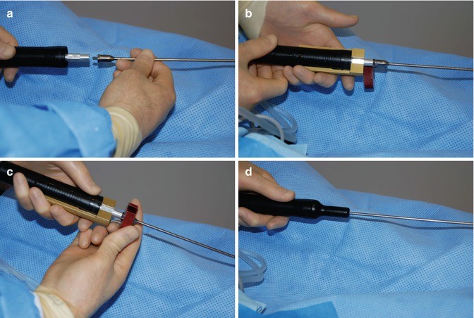 VASER Technology for Ultrasound-Assisted Lipoplasty | SpringerLink