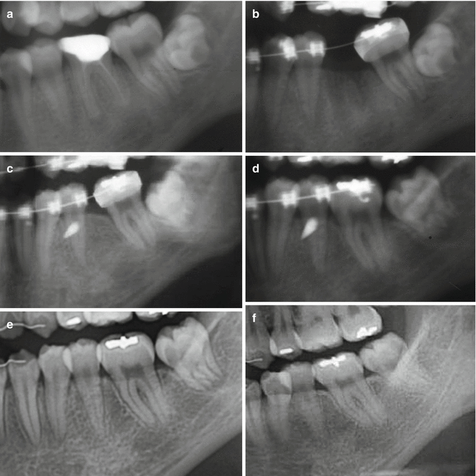 Molar Protraction: Orthodontic Substitution of Missing Posterior Teeth ...
