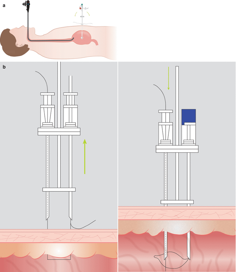 Percutaneous Endoscopic Gastrostomy | SpringerLink