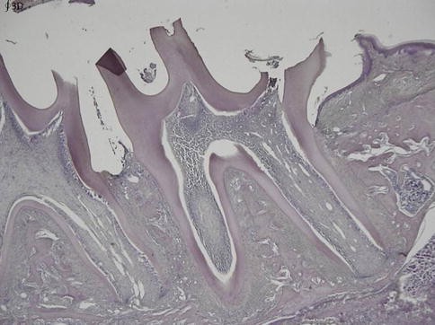 Pulp Aging: Fibrosis and Calcospherites | SpringerLink