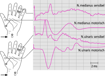 Kompressionssyndrome des N. medianus | SpringerLink