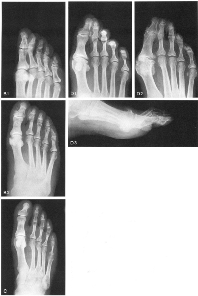 Hallux Rigidus | SpringerLink