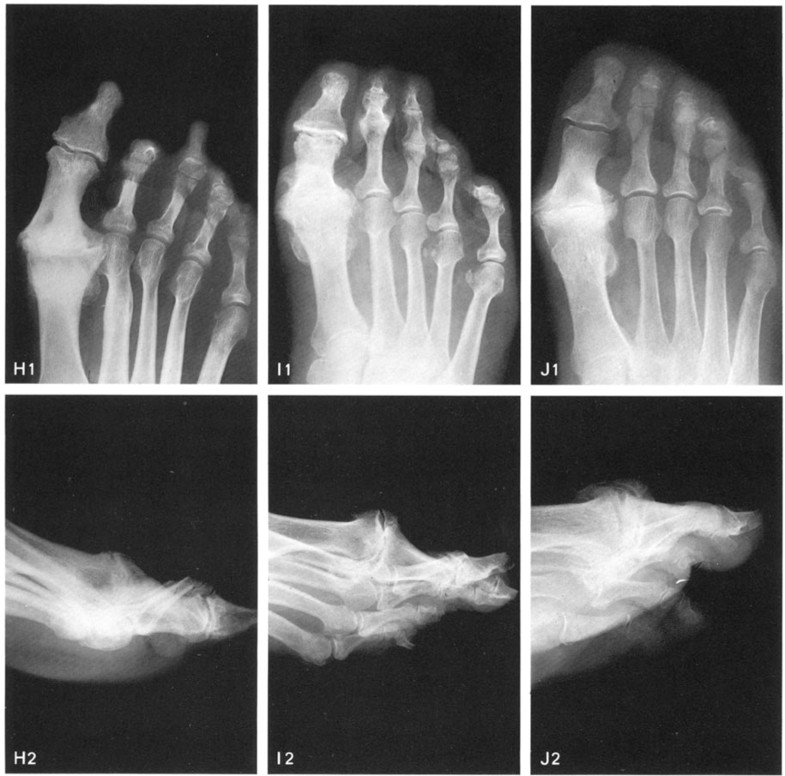 Hallux Rigidus | SpringerLink