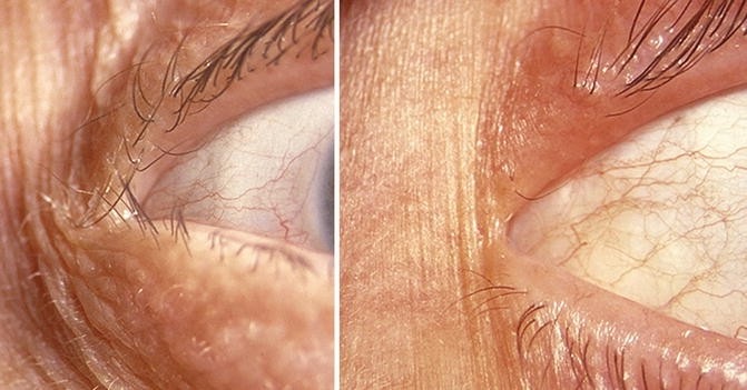 Cryosurgery for Benign Eyelid Lesions | SpringerLink