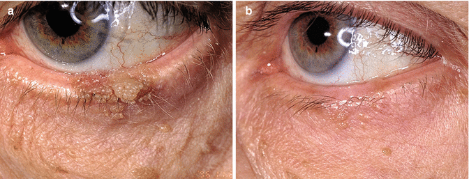 Cryosurgery for Benign Eyelid Lesions | SpringerLink