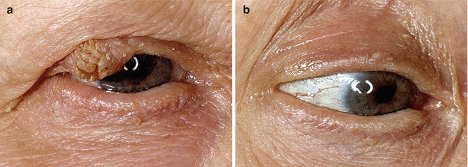 Cryosurgery for Benign Eyelid Lesions | SpringerLink