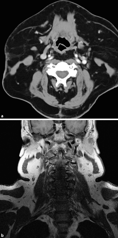 Larynx, Hypopharynx and Soft Tissue of the Neck | SpringerLink