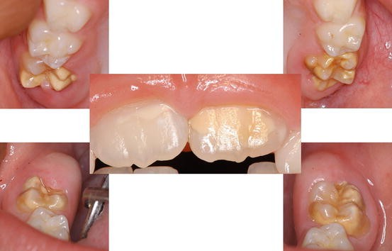 Molar Incisor Hypomineralization and Hypomineralized Second Primary ...