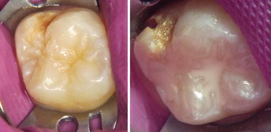 Molar Incisor Hypomineralization and Hypomineralized Second Primary ...