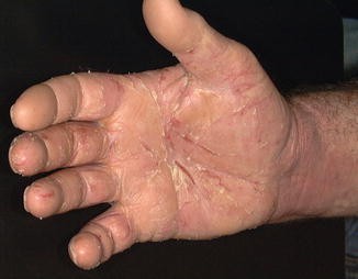 Grenz Ray and Ultrasoft X-Ray Therapy | SpringerLink