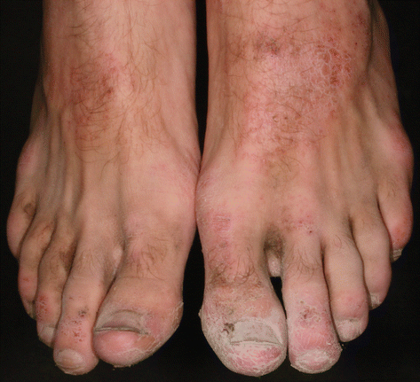 Clinical Features of Contact Dermatitis | SpringerLink