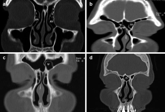 Surgical Anatomy and Embryology of the Frontal Sinus | SpringerLink