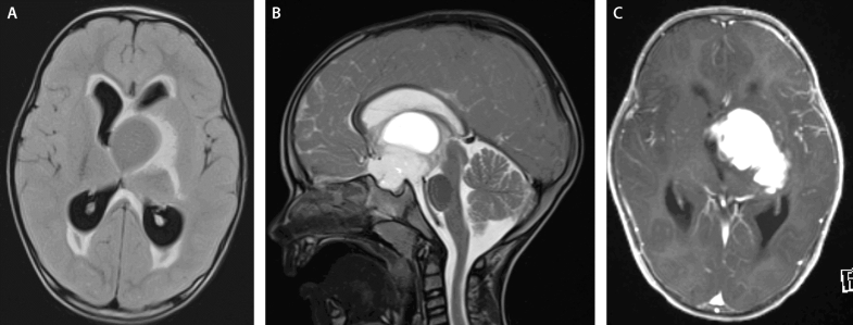 Optische Gliome bei Kindern | SpringerLink