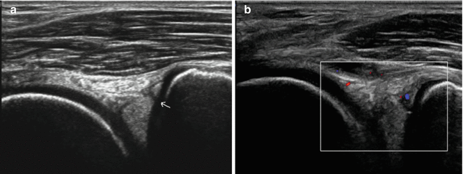 Meniscus Ultrasound | SpringerLink