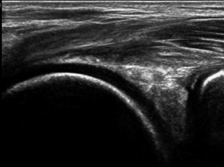 Meniscus Ultrasound | SpringerLink