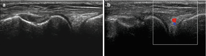 Meniscus Ultrasound | SpringerLink