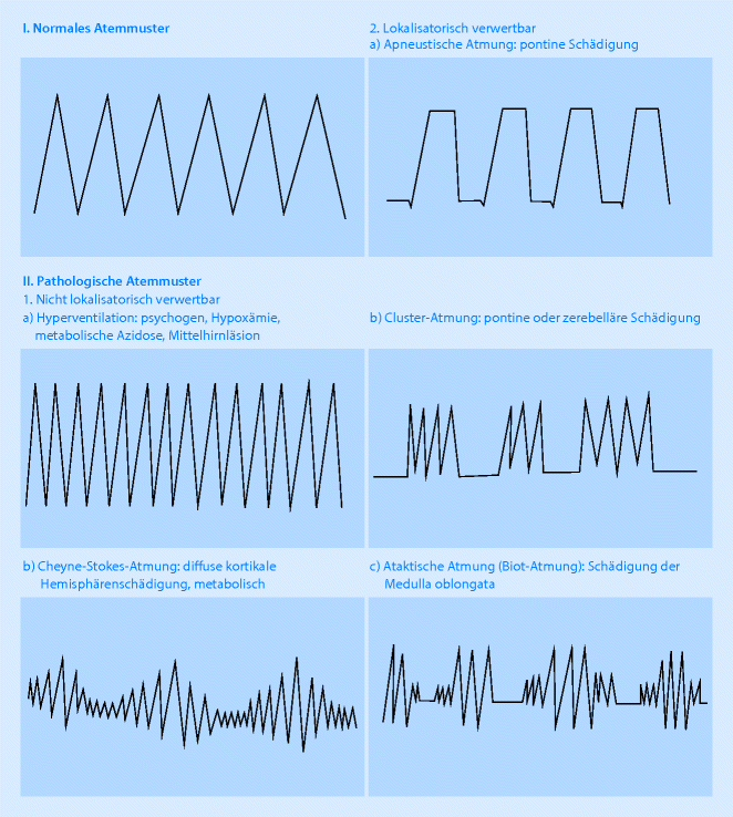 Fallbeispiel Neurochirurgie – Hirndruck | SpringerLink